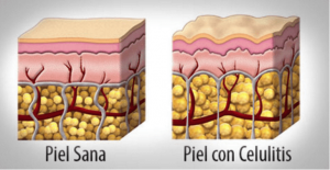 ¿Conoces los distintos tipos de celulitis? | Sentir & Ser