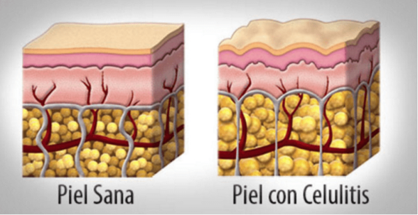 ¿Conoces los distintos tipos de celulitis? | Sentir & Ser